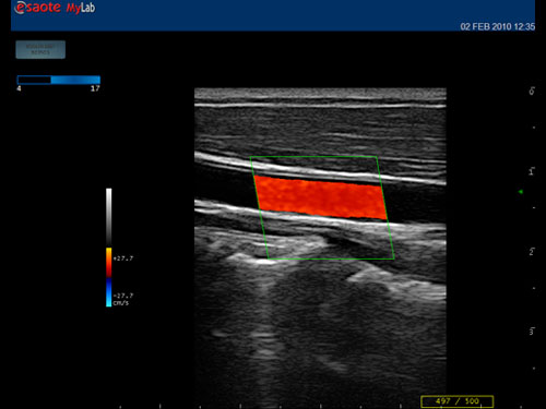 Carotis-Screening - Ultraschallmessung der Halsschlagader | UBGM