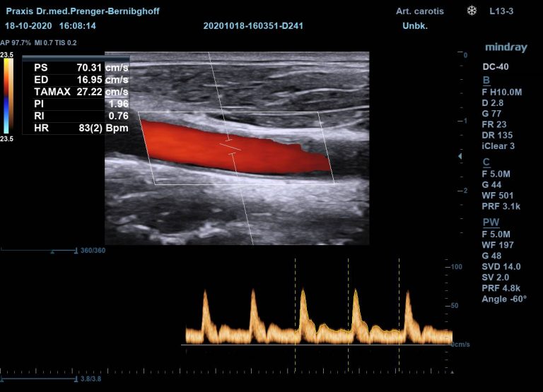 Carotis-Screening - Ultraschallmessung der Halsschlagader